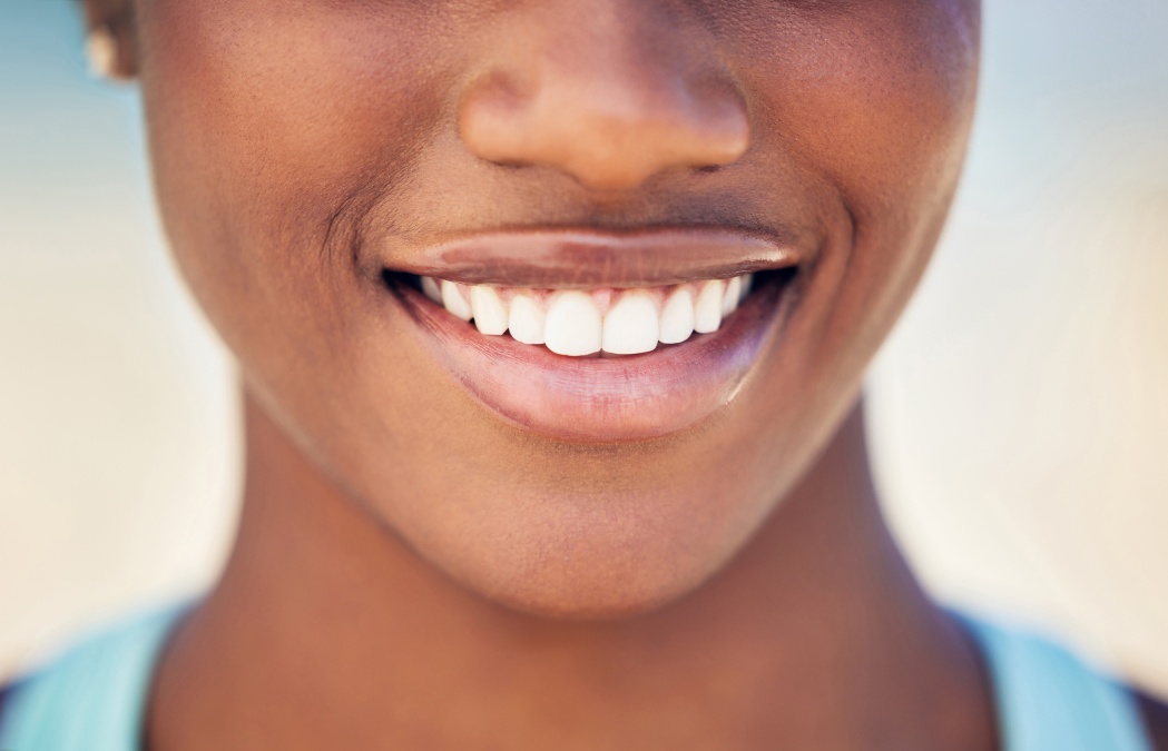 Teeth Whitening: Before and After | Active Dental Dallas-Fort Worth, TX